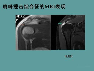 带你了解肩关节常见病变的MRI影像学