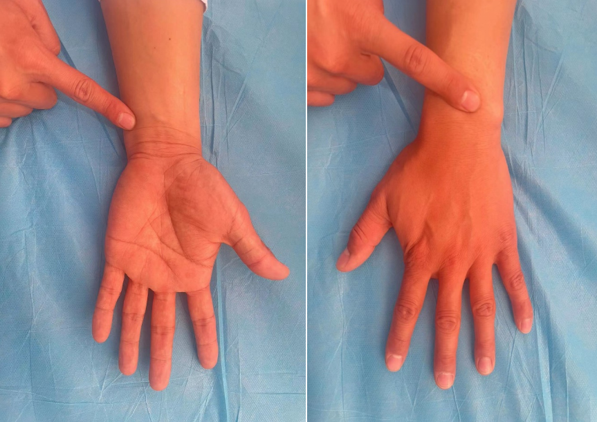 健康课堂：有一种腕部疼痛是TFCC损伤