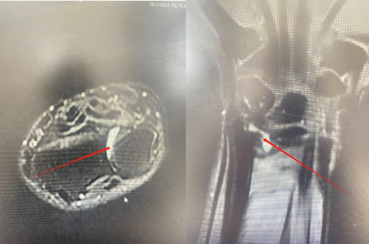 健康课堂：有一种腕部疼痛是TFCC损伤